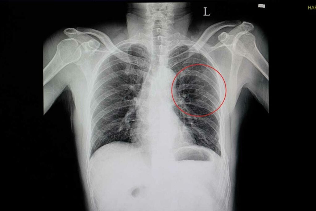 Seat Belt Syndrome | Total Vitality Medical Group